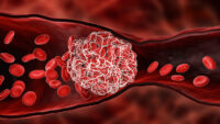 The Dangers of Blood Clots for Seniors | Bethesda Health Group
